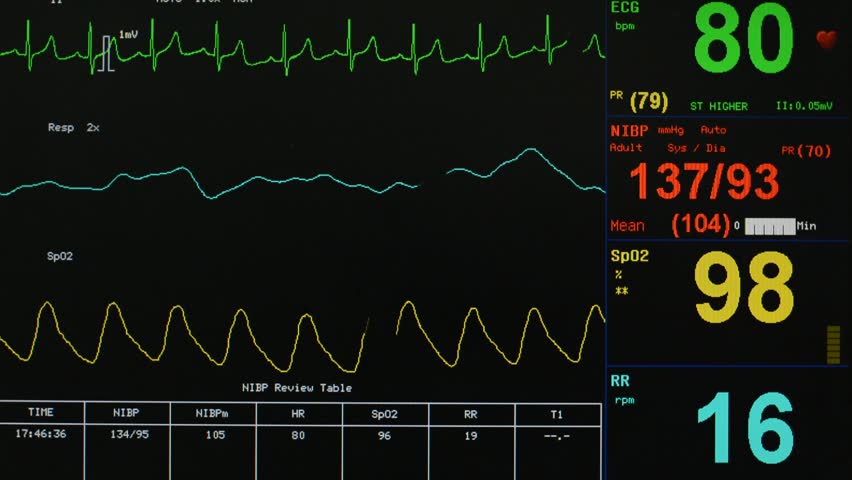 Looped: Patient Monitor Displays Vital Signs ECG Electrocardiogram EKG ...