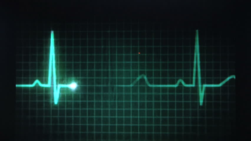 Animation Of Schematic Diagram Of Normal Sinus Rhythm For A Human Heart ...